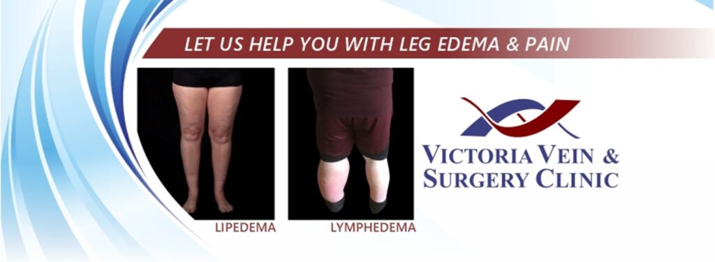 Leg Edema - Victoria Vein & Surgery Clinic